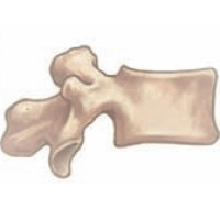 Congenital scoliosis with unilateral failure of vertebral segmentation ...